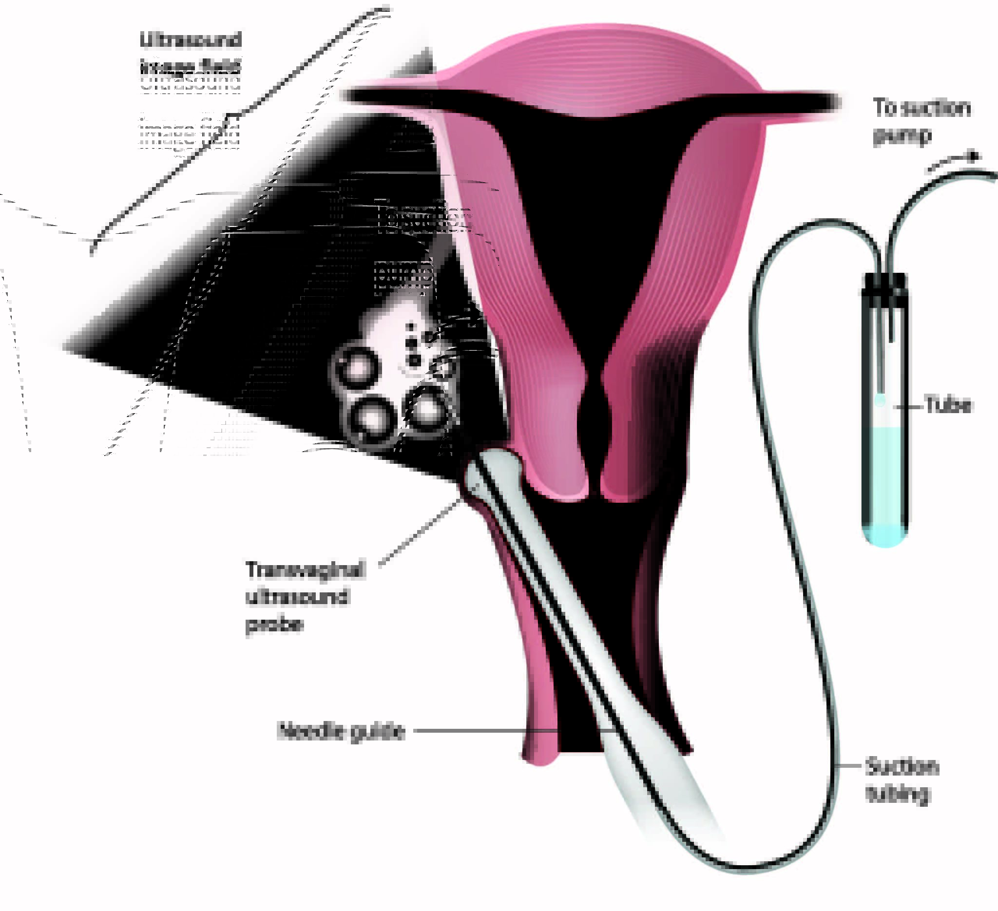 IVF Procedures & Fee - Vinsfertility.com